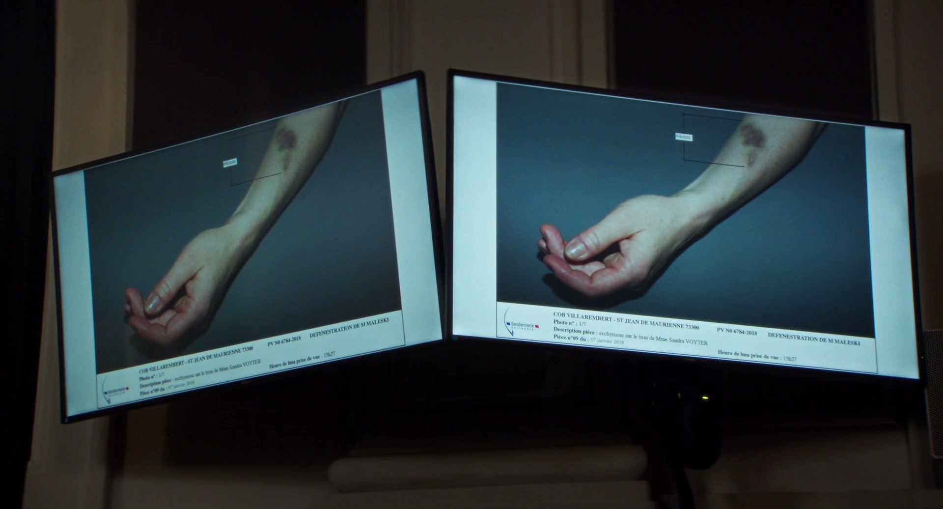 She initially told usshe'd bumped into a kitchen counter. - Anatomy of ...