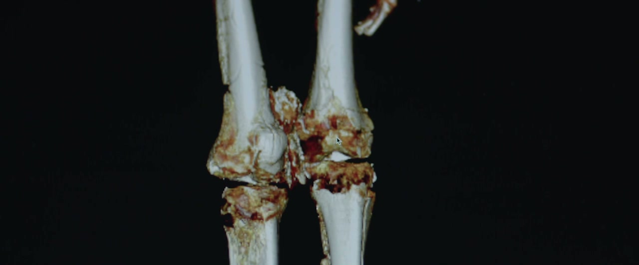 Which meansthat the fracture was there before mummification 'causethere ...