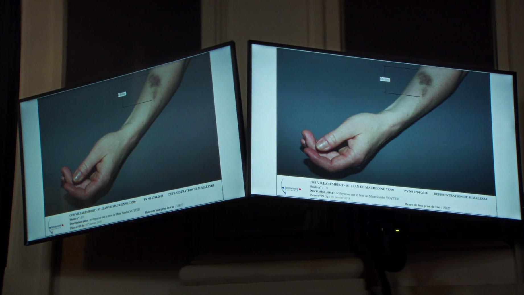 She initially told usshe'd bumped into a kitchen counter. - Anatomy of ...